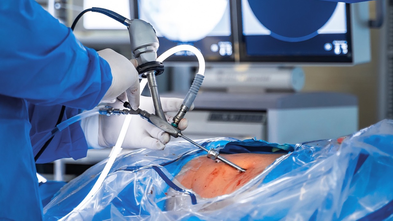 What to Know About Percutaneous Nephrolithotomy (PCNL)