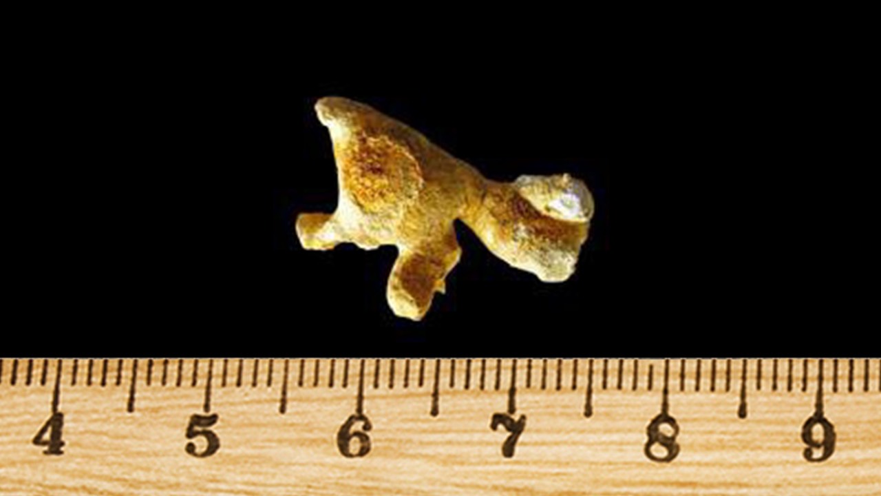 Staghorn Kidney Stones