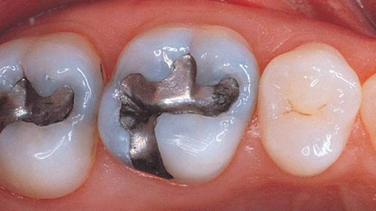 Metal fillings attract fungus and cause leaky gut