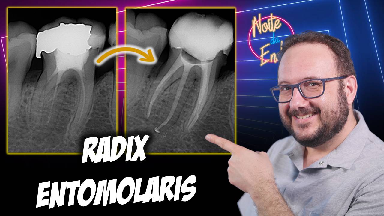 Retratamento de 46 Radix Entomolaris - Caso Clínico passo-a-passo