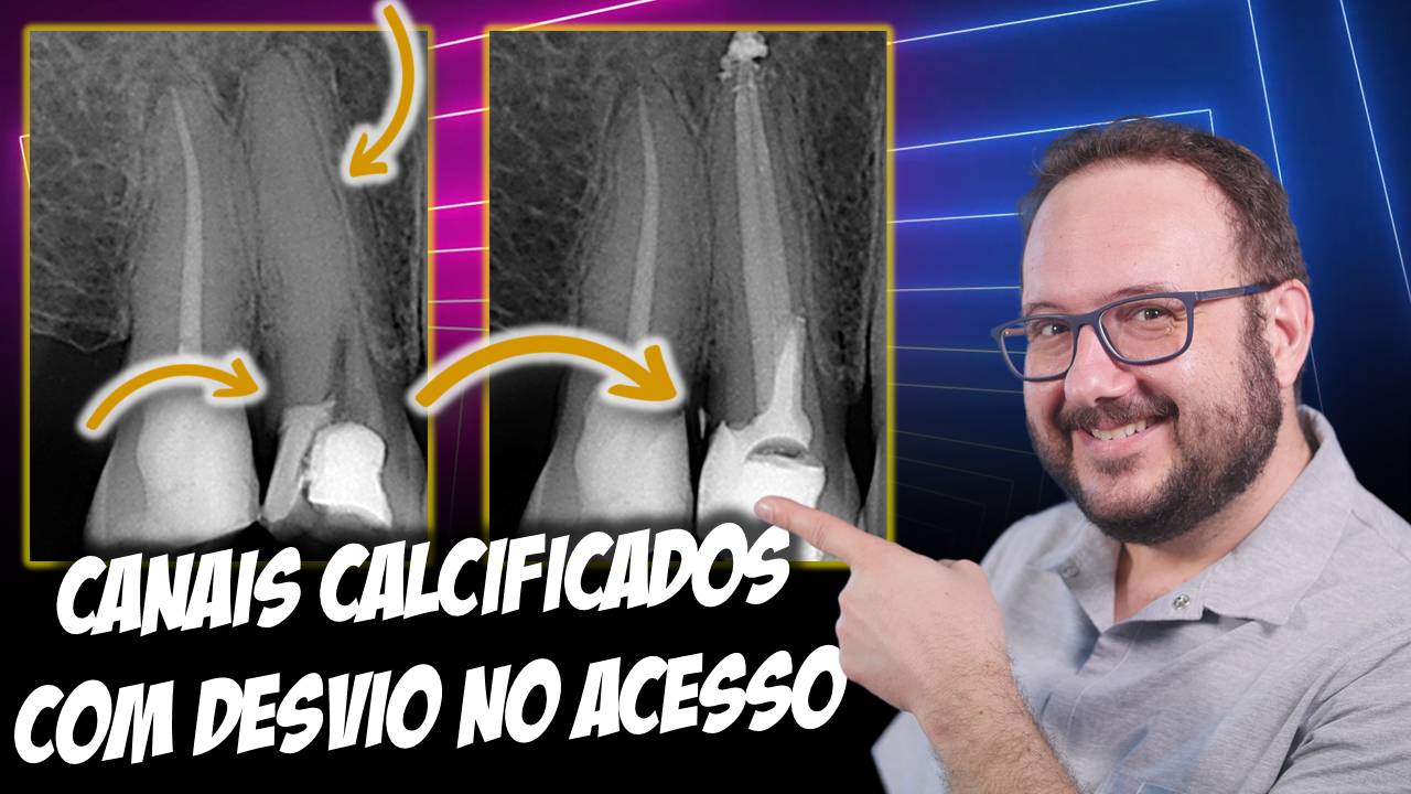 14 com canais severamente calcificados e desvio no acesso