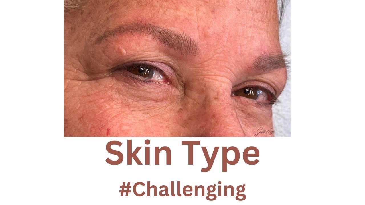 Tattooing over damaged skin types