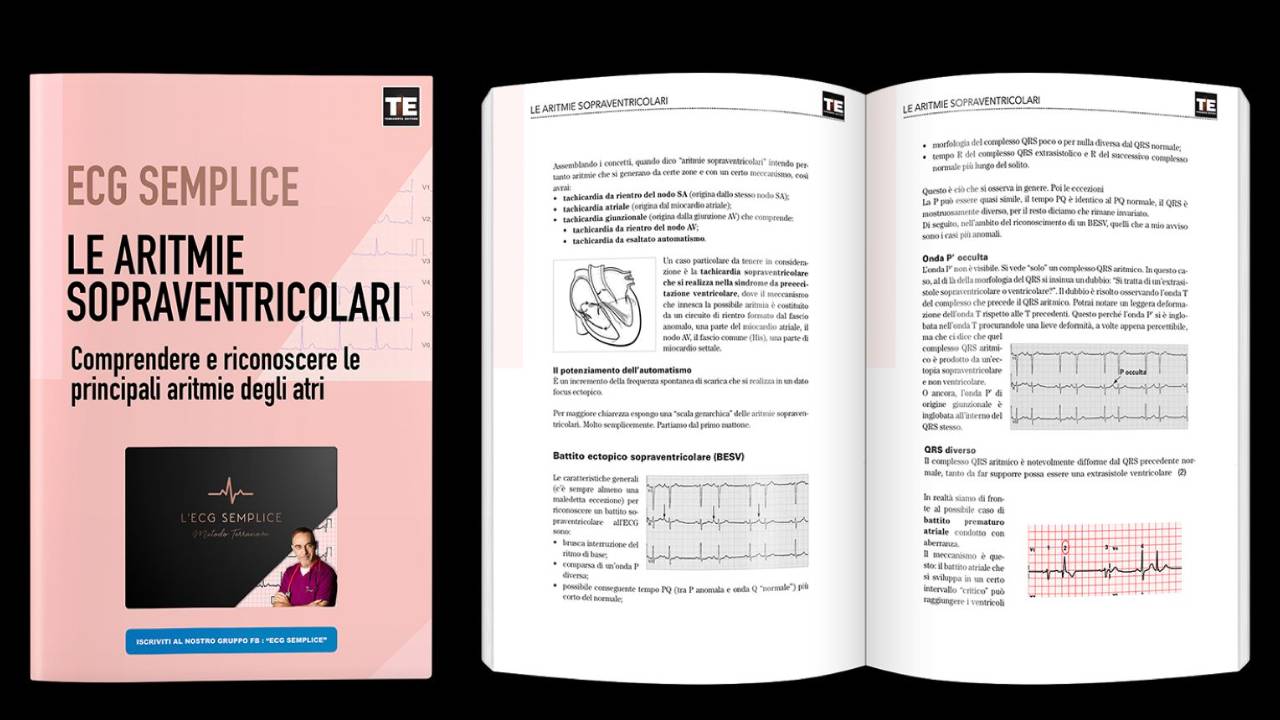 Brochure Aritmie Sopraventricolari