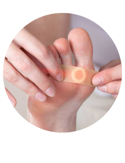 Verruca Treatment- Locksbottom Podiatry