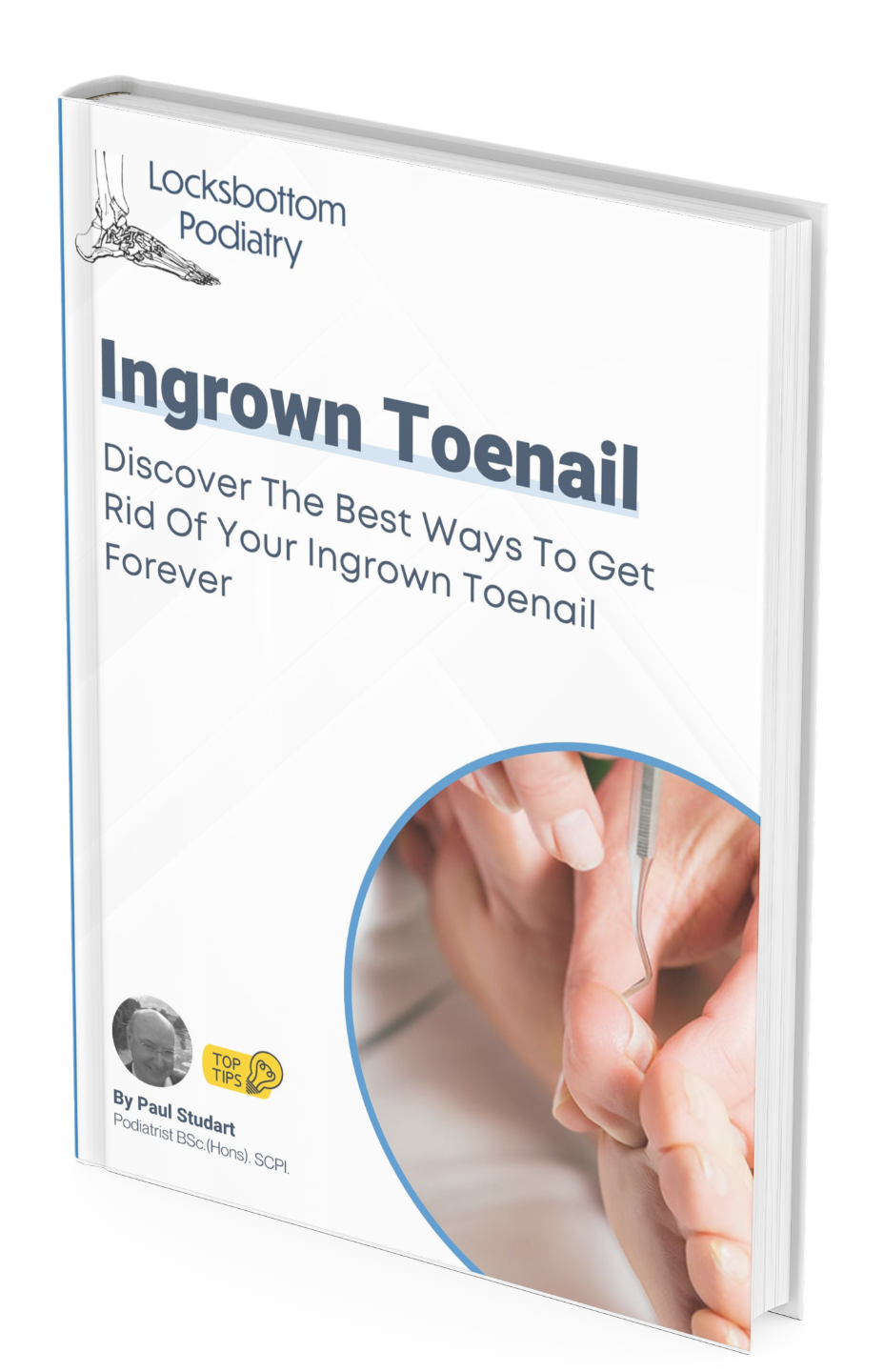 Ingrown Toenail - Locksbottom Podiatry