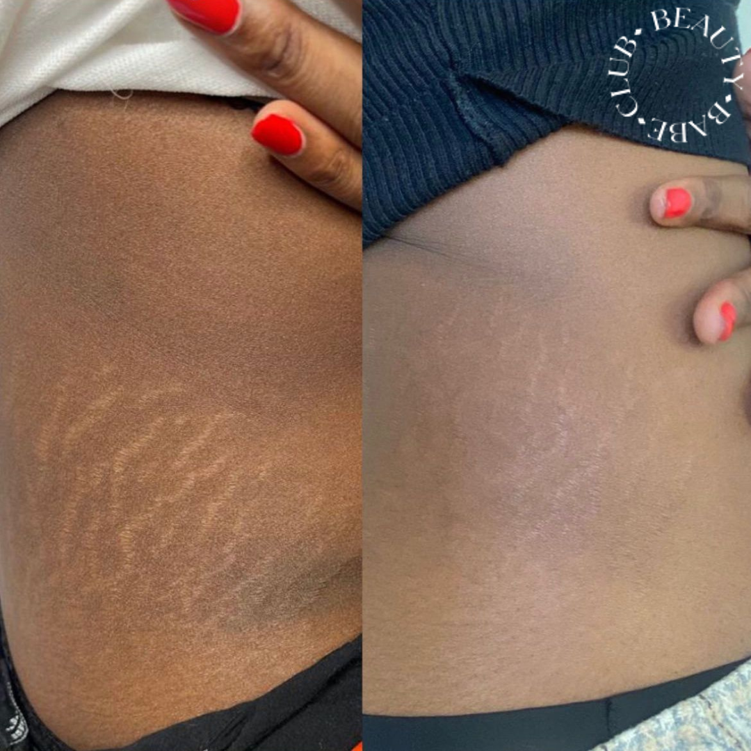 Transform Lives With Inkless Stretch Mark Removal Training Transform Lives With Inkless Stretch Mark Removal Training