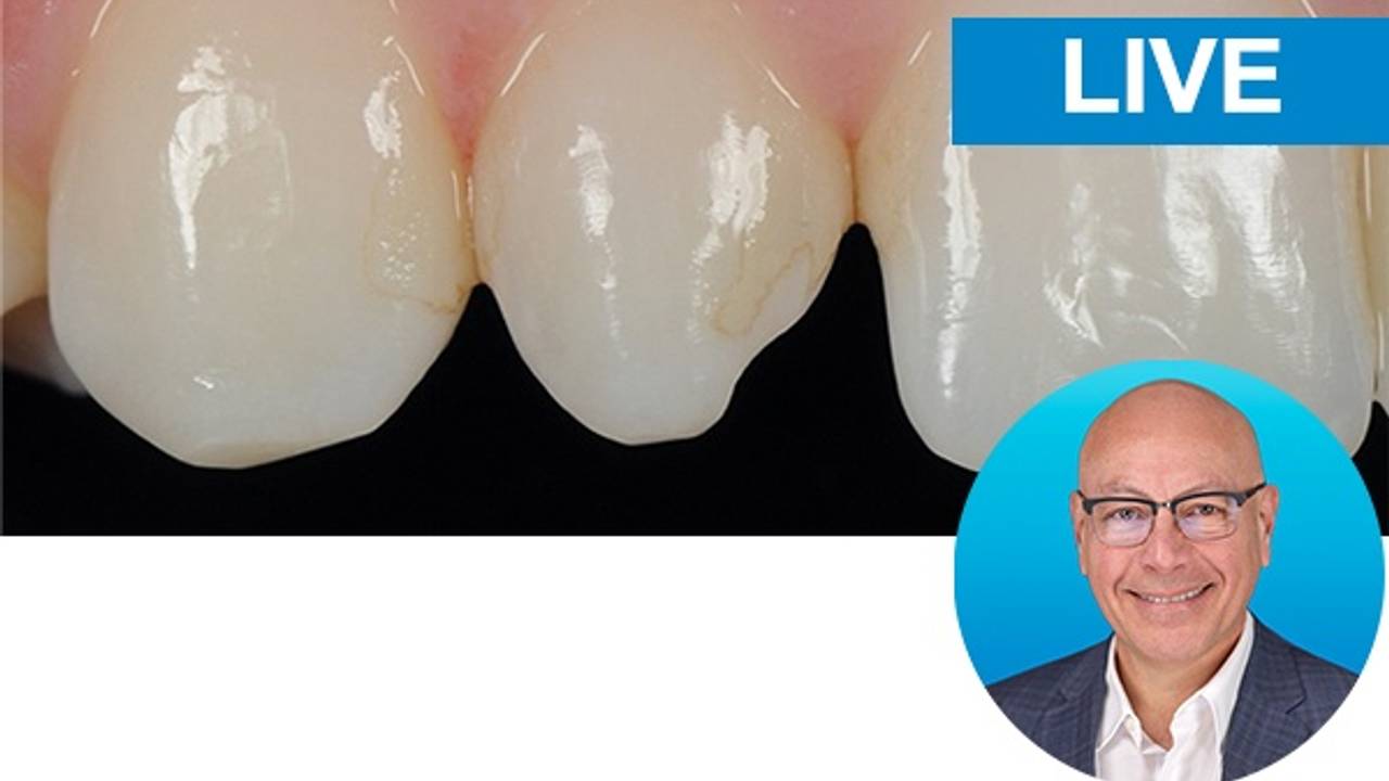 Esthetic Peg Lateral & Class III Direct Restorations with Dr. Vargas