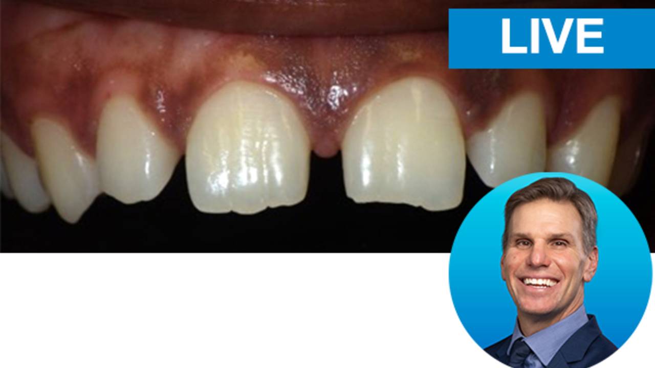 Predictable Diastema Closures Using the Bioclear Method