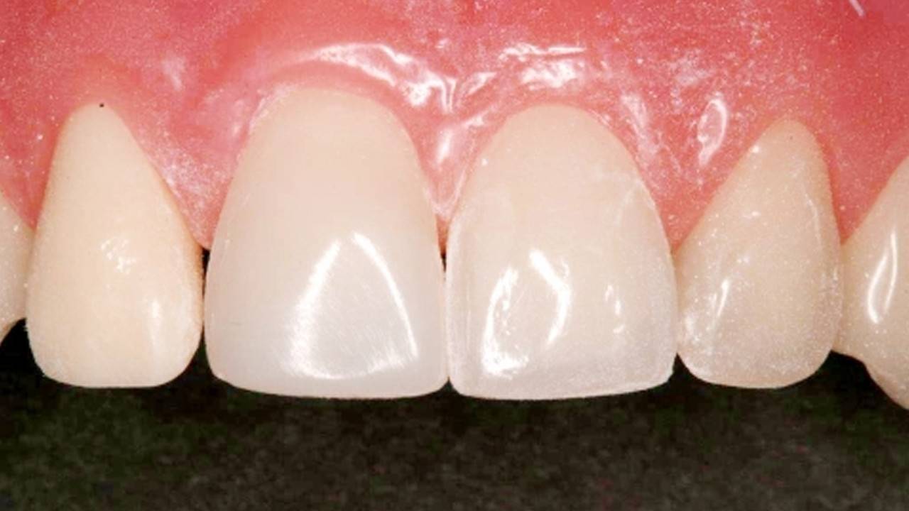 The Lingual Matrix Technique