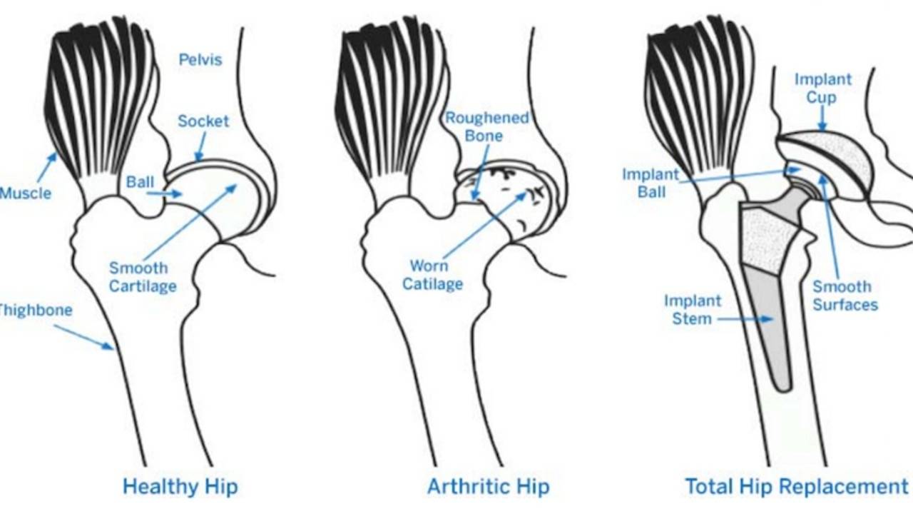 New Hip, New Limp - Total Hip replacement.