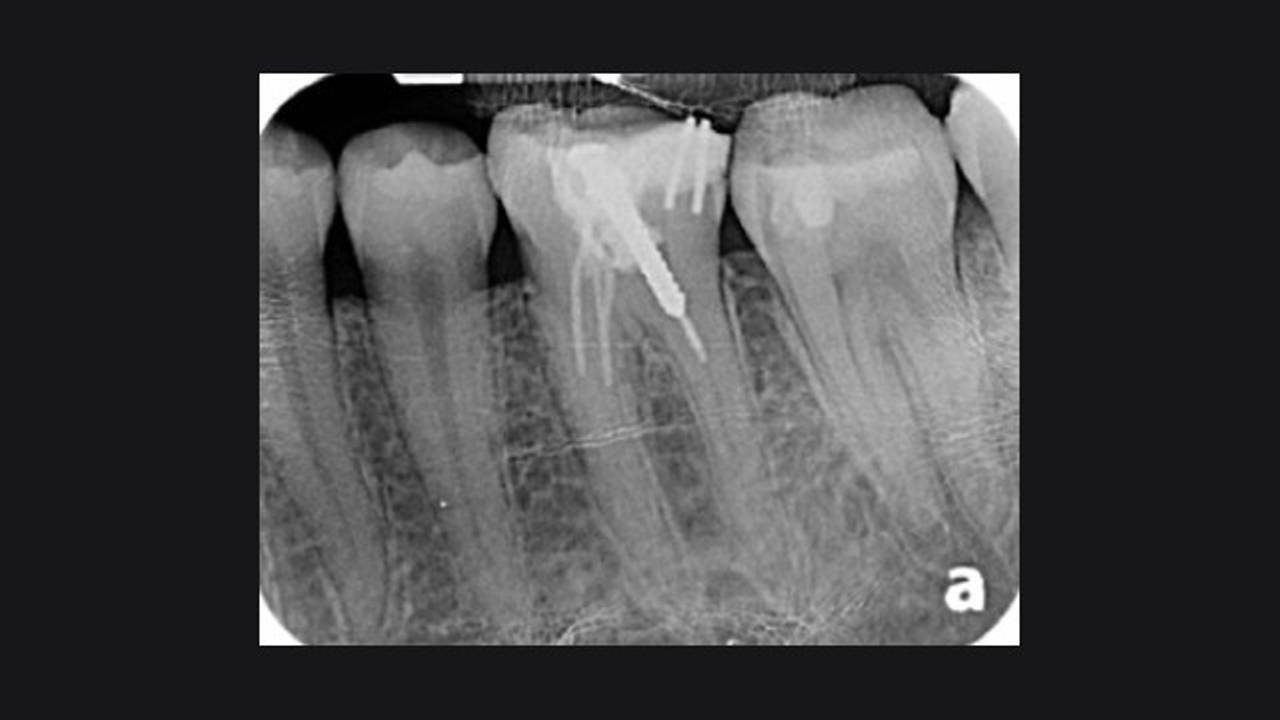 How to complete surgical extractions correctly Pt. 2