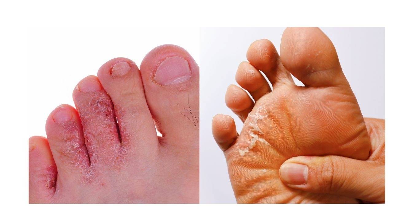 Do you have itchy, red or scaly feet? It could be Athletes Foot!