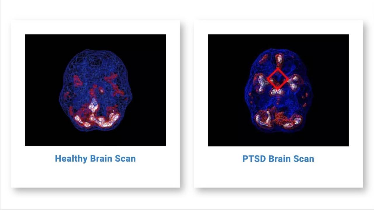 Amen University I Seeing PTSD on a SPECT Scan