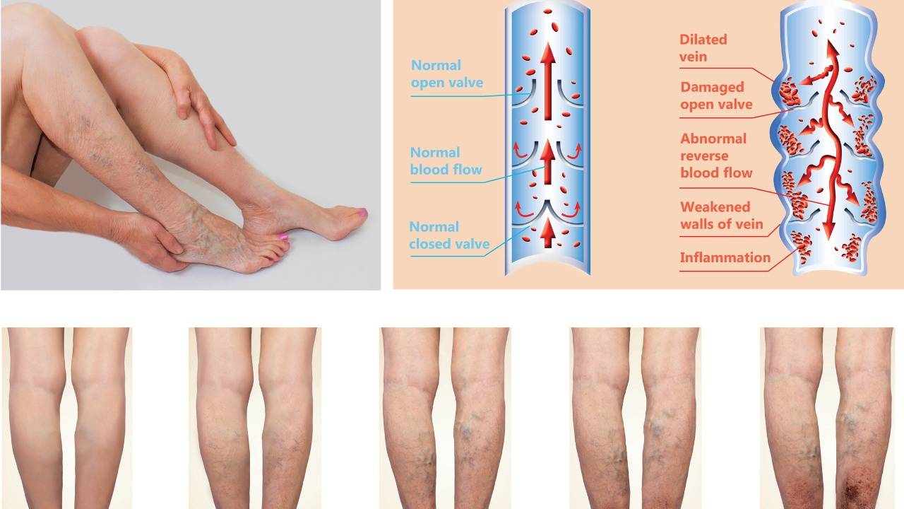 World Thrombosis day! Warning signs to prevent premature death