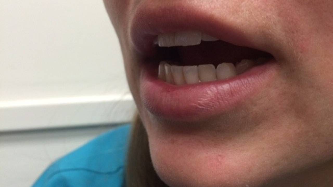 Does trismus go away on its own?