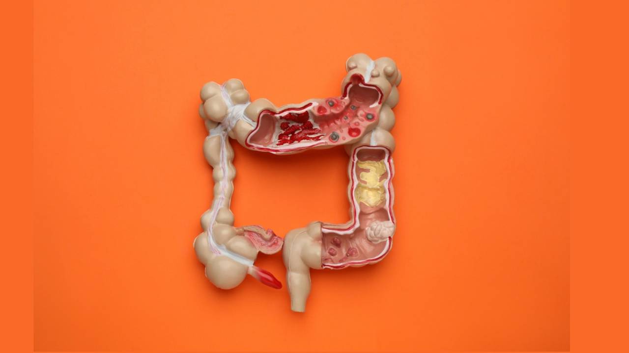 Colitis Ulcerosa - Síntomas, Diagnóstico y Tratamiento