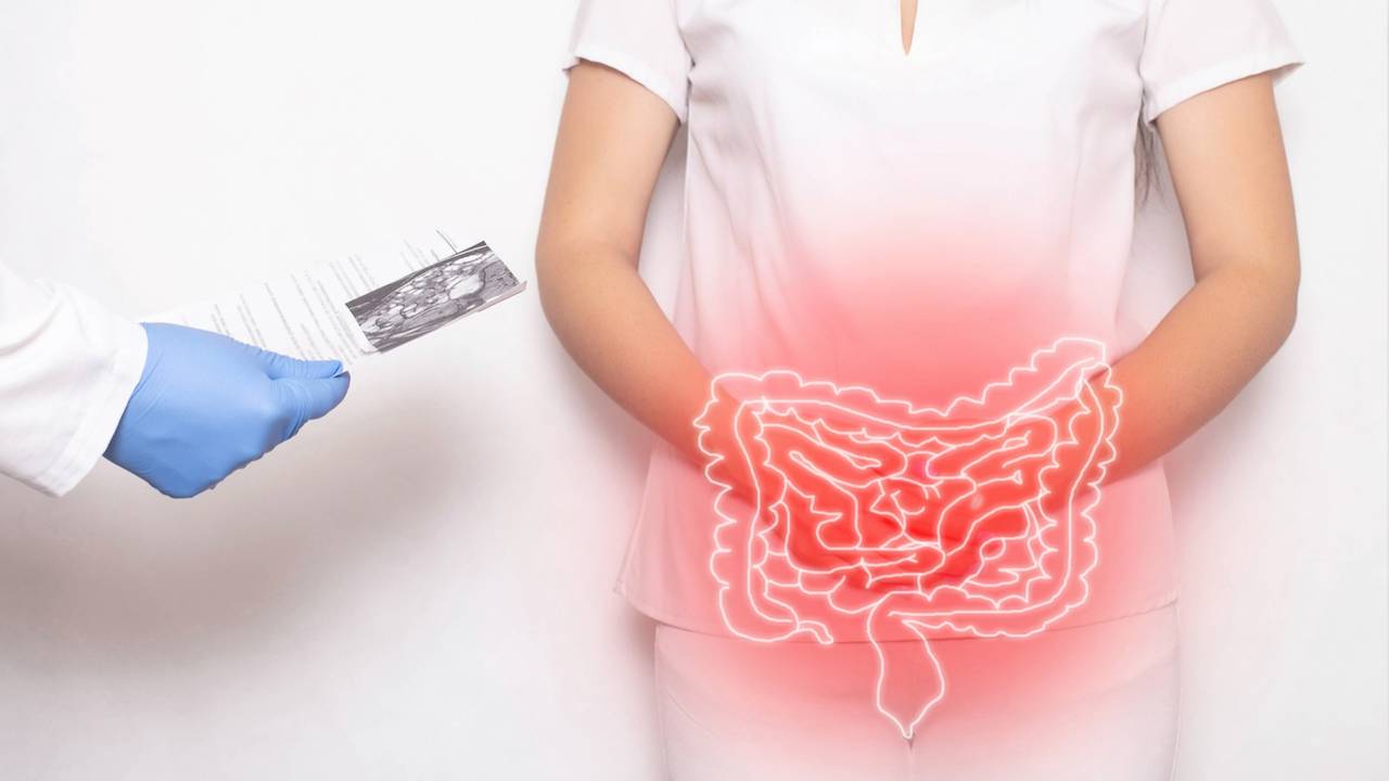 Megacolon Tóxico - qué es, causas, síntomas, tratamiento