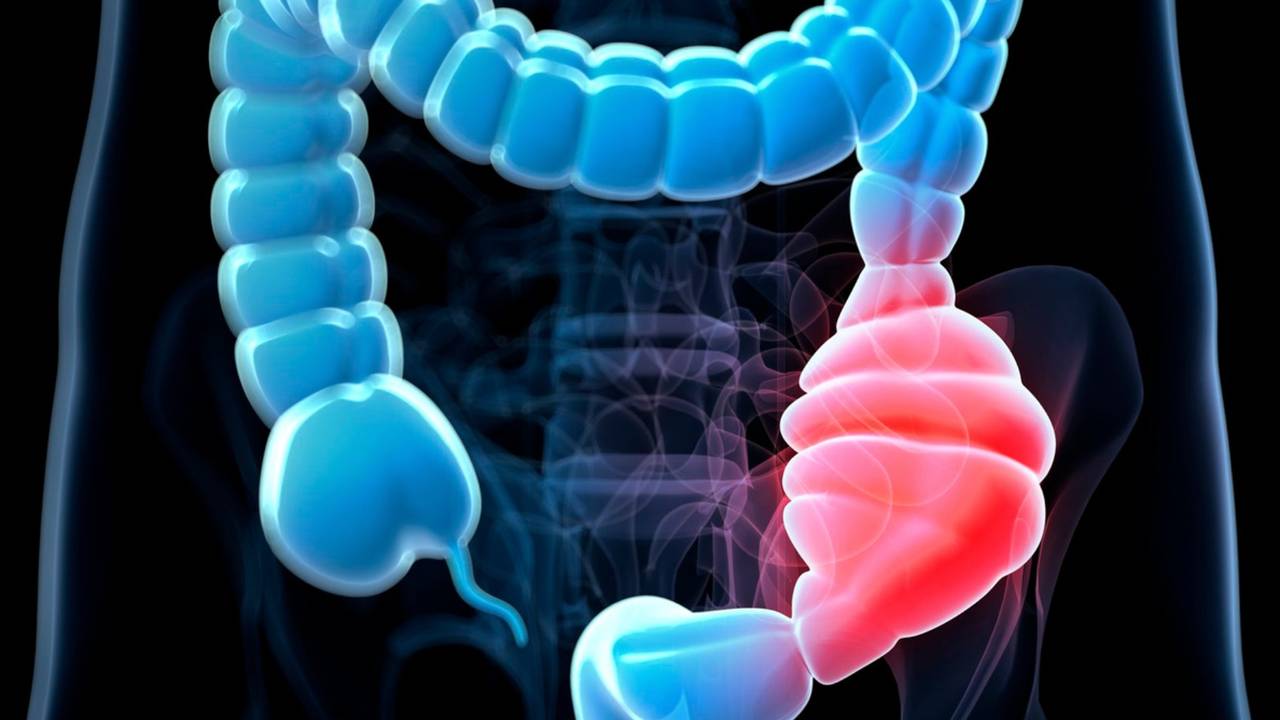 Megacolon - qué es, causas, síntomas, tratamiento