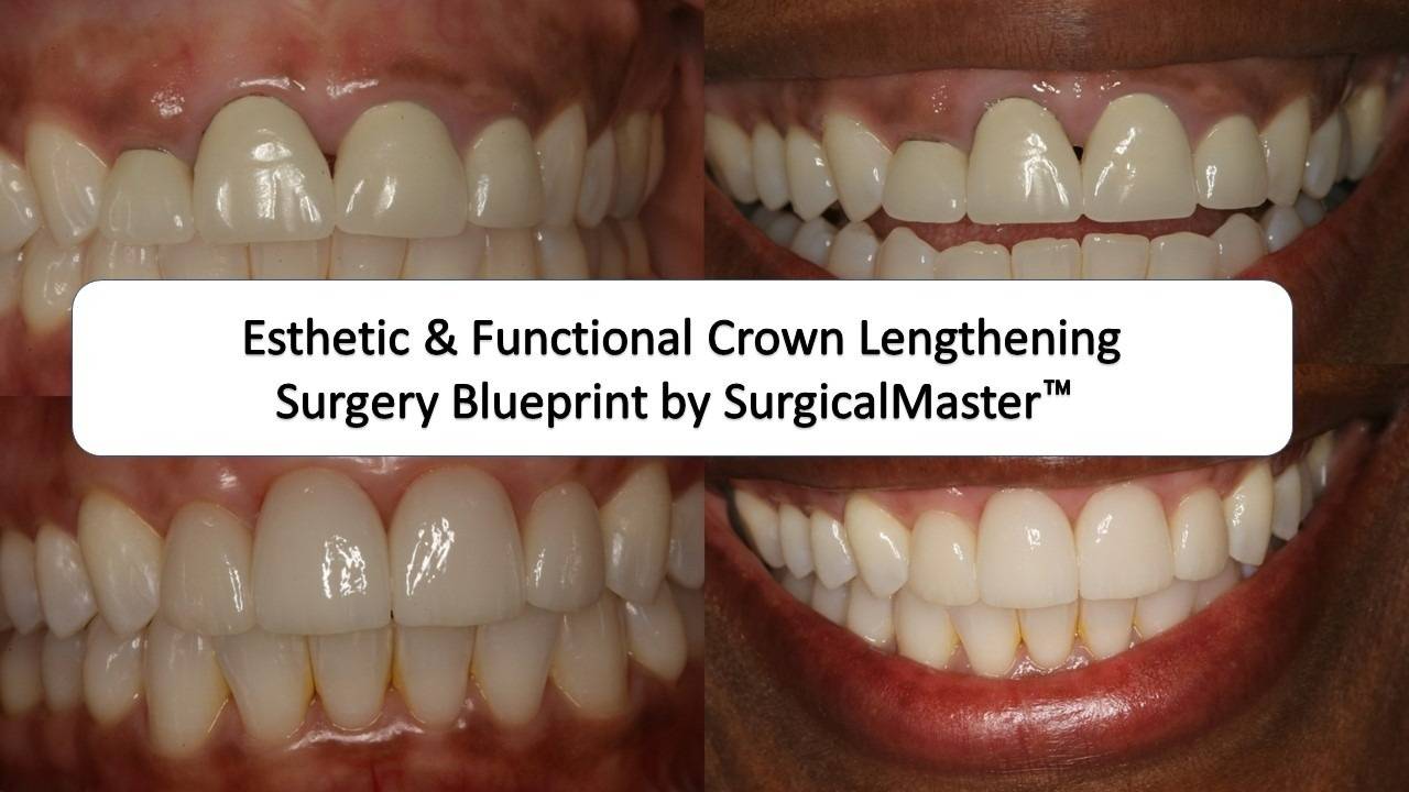 Esthetic & Functional Crown Lengthening Blueprint by SurgicalMaster™