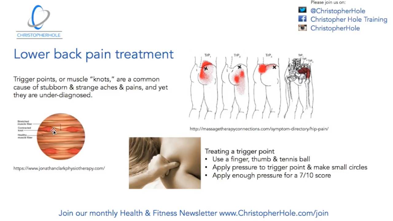 Low back pain treatment: Trigger points