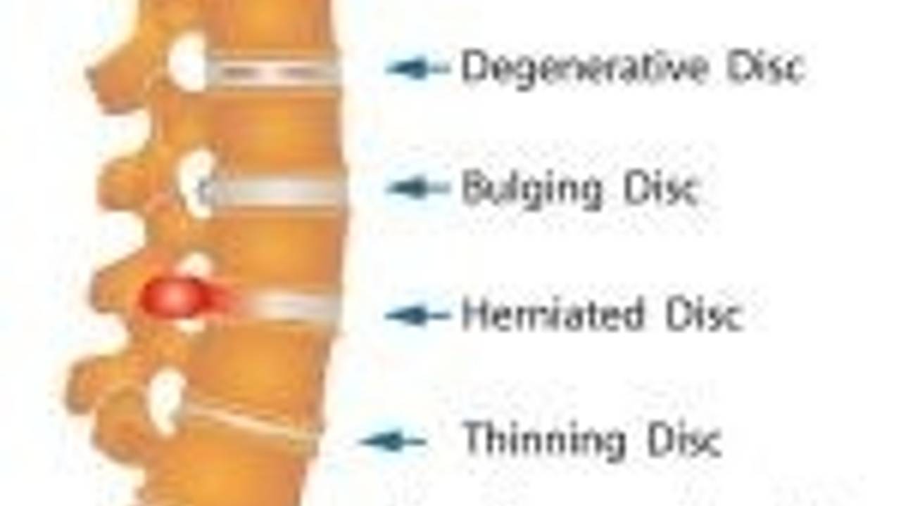 What can go wrong with the spinal discs?