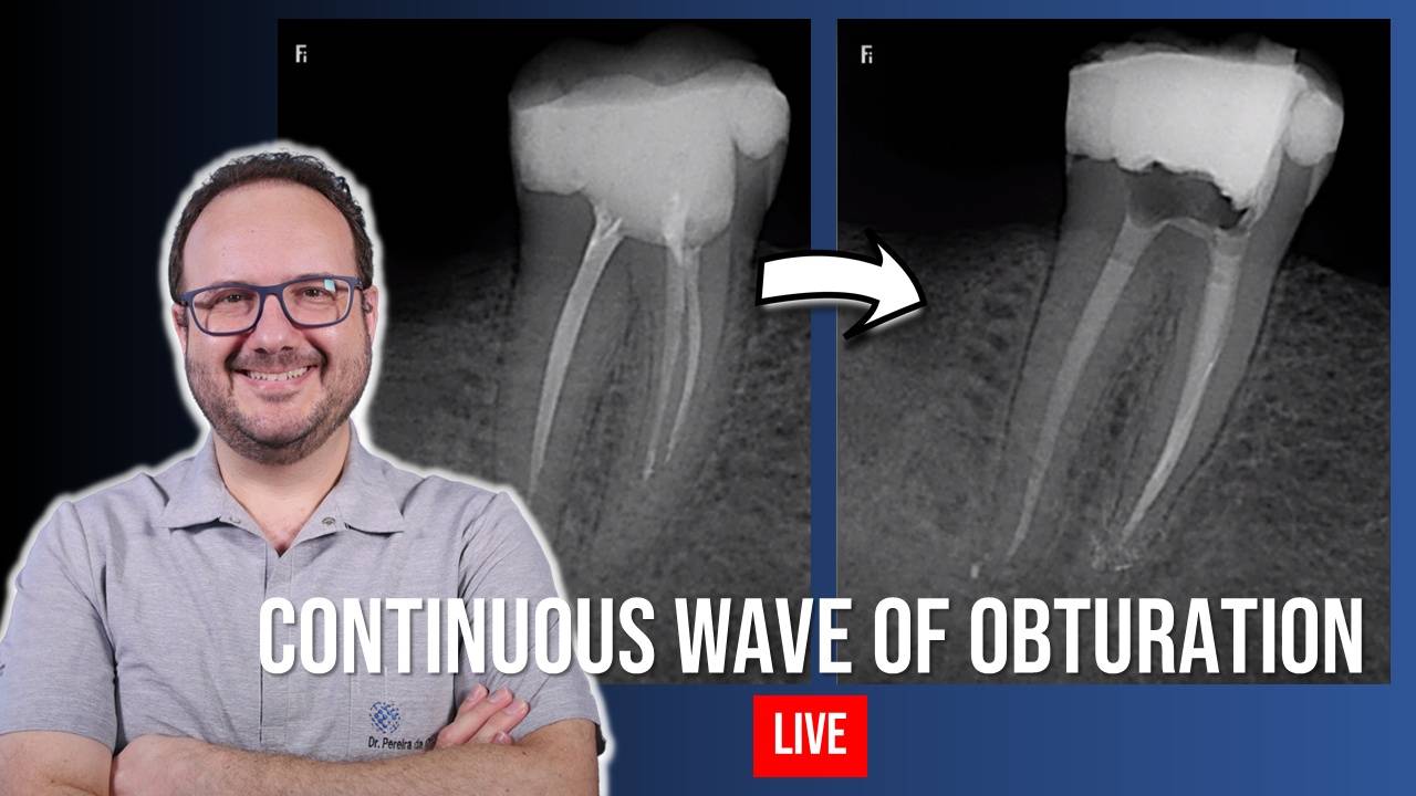Obturation with Continuous Wave of Condensation on Tooth 46 - Part 2