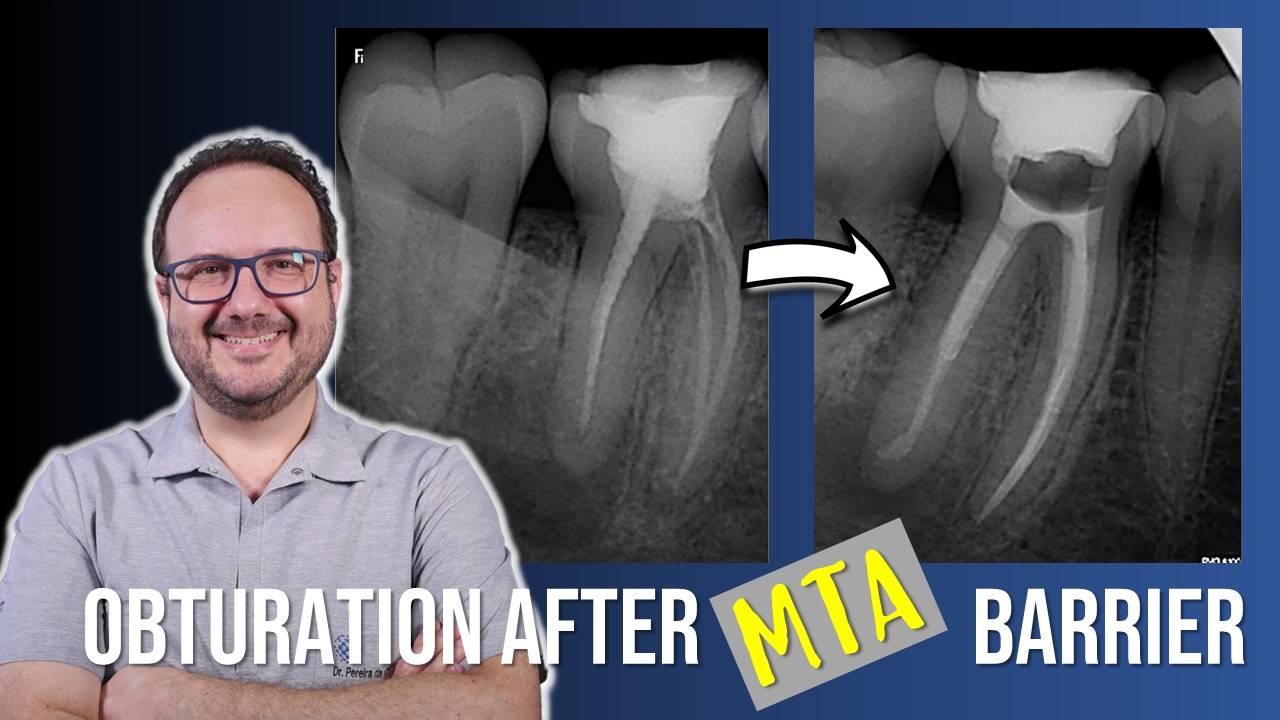 Obturation after MTA Apical Barrier - Part 2