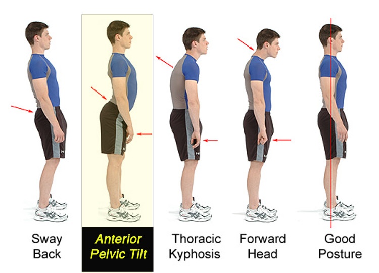 The No B S Guide To Anterior Pelvic Tilt The No B S Guide To Anterior Pelvic Tilt