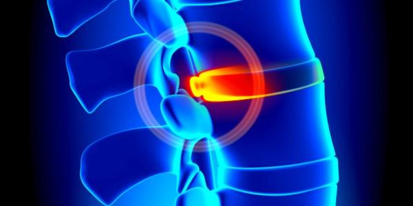 Spinal Stenosis and IDD Therapy
